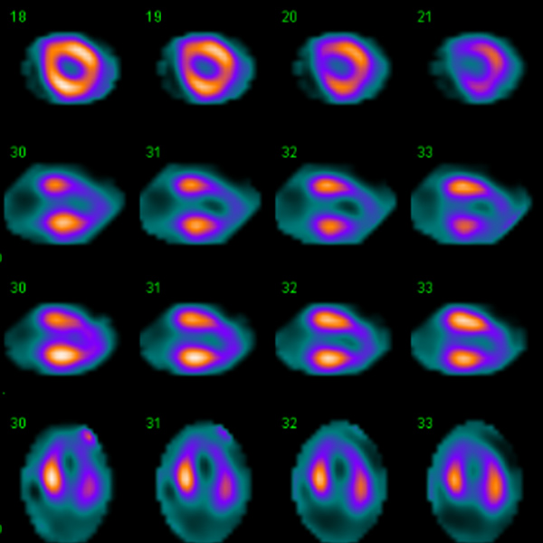 ACC Member Experience: Highlights From the 24th ASNC Scientific Meeting ...