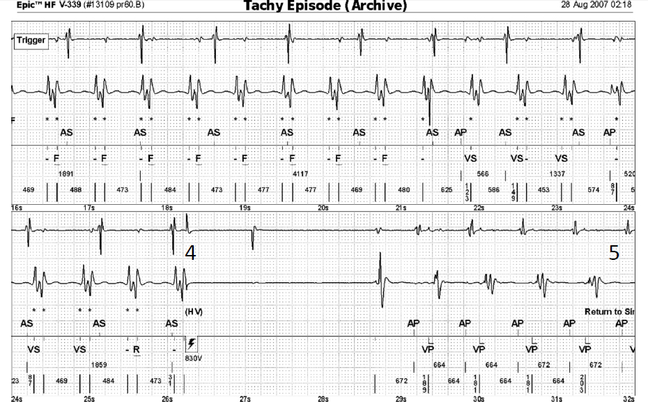 Ventricular Tachycardia With Double Counting of the R-Wave | Bordeaux ...