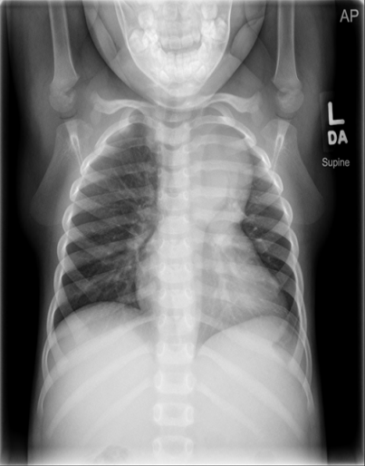 A Child With a Murmur and an Unusual Chest X-ray - American College of ...