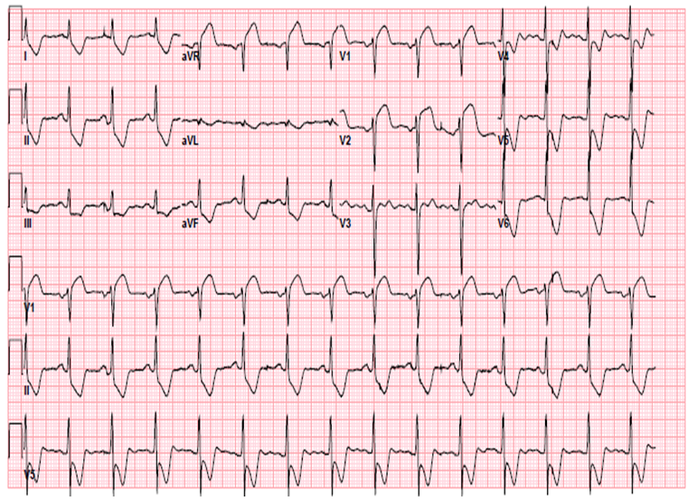 Aortography in Acute Aortic Dissection: An Undervalued Gold Standard ...