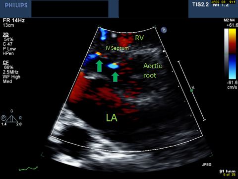 Unusual Flow in the Interventricular Septum After Septal Myectomy ...