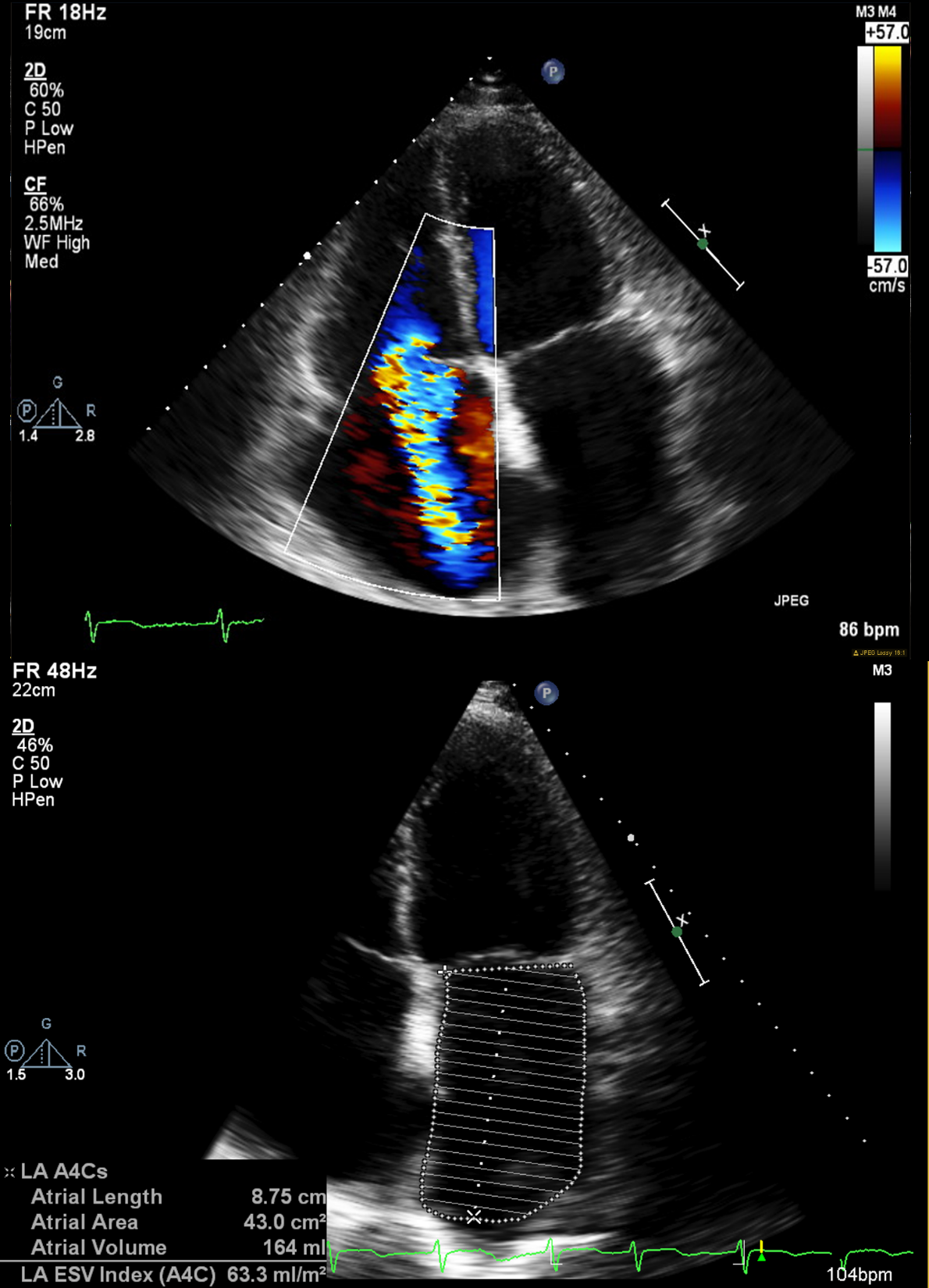 Recurrent AF After Ablation - American College of Cardiology