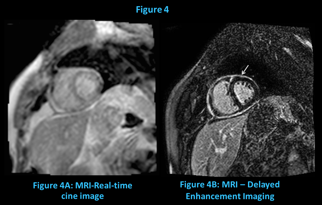 A Case of Pericarditis: Should We Treat Medically or Surgically ...
