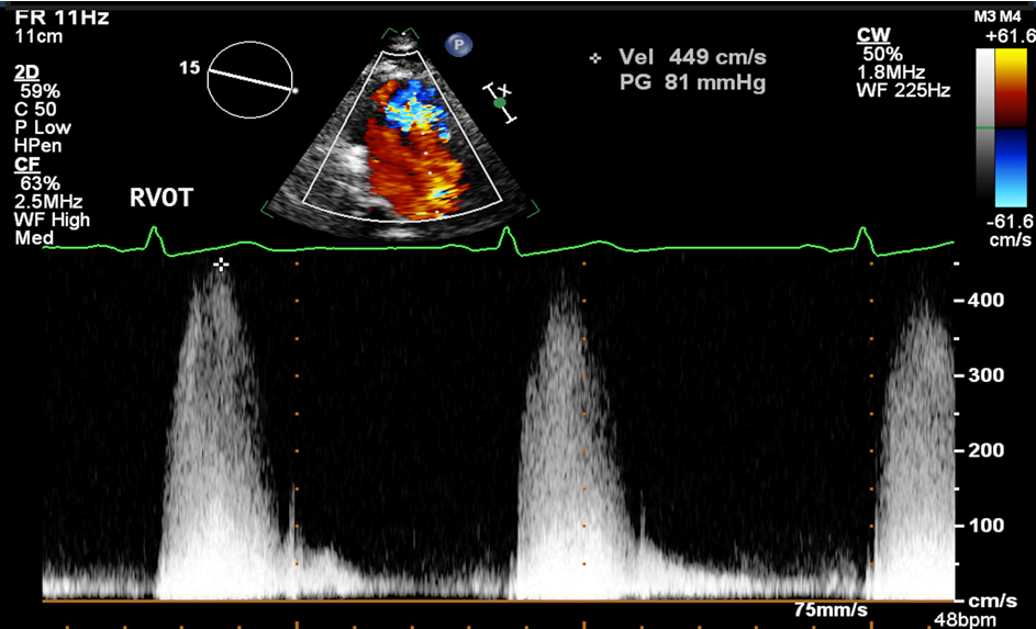 A Case of a Not-So-Benign Murmur - American College of Cardiology