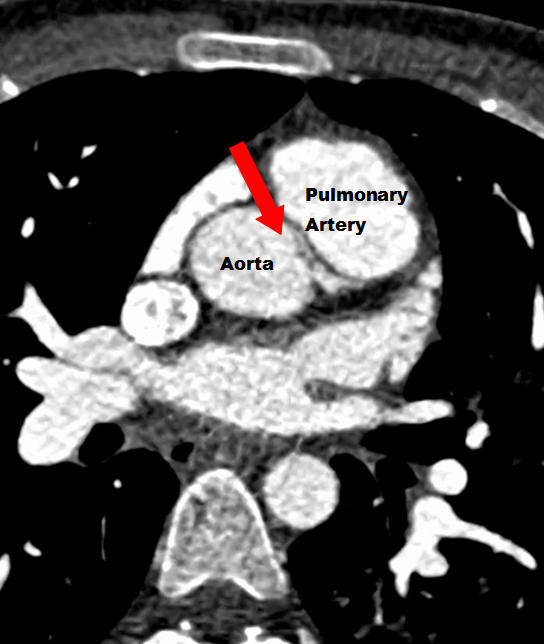 A Case of Sudden Cardiac Death in a Healthy, Athletic Woman - American ...