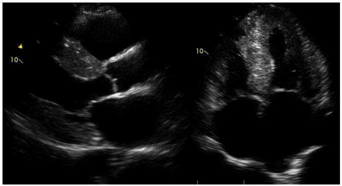 Technetium-99m Pyrophosphate SPECT for TTR Amyloid - American College ...