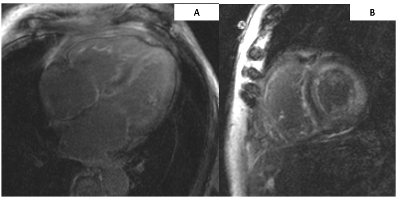 Technetium-99m Pyrophosphate SPECT for TTR Amyloid - American College ...