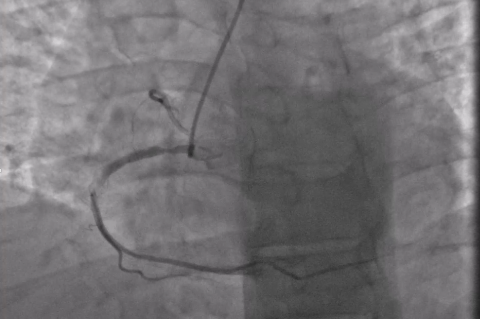 A 54-Year-Old Man With an NSTEMI and Upcoming Non-Cardiac Surgery ...