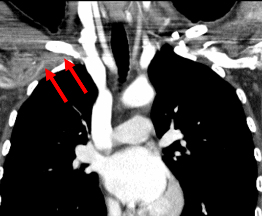 Effort Thrombosis - American College of Cardiology