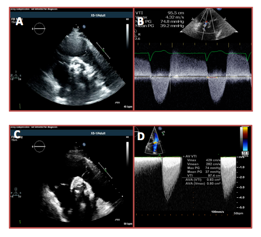 Persistent Shortness of Breath Following Bioprosthetic Valve-in-Valve ...