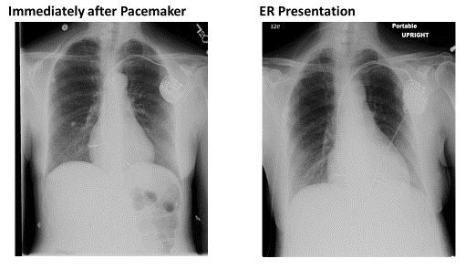 Chest Pain After Pacemaker Implantation - American College of Cardiology
