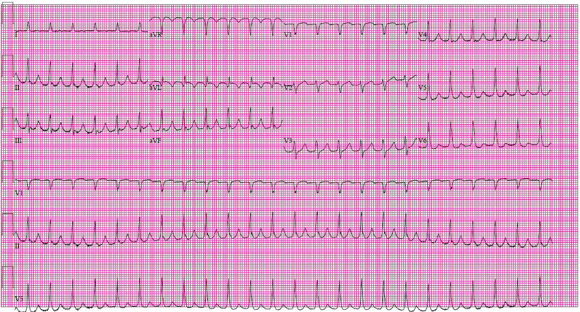 ECG of the Month: 68-Year-Old Male with A Bioprosthetic AVR for AS ...