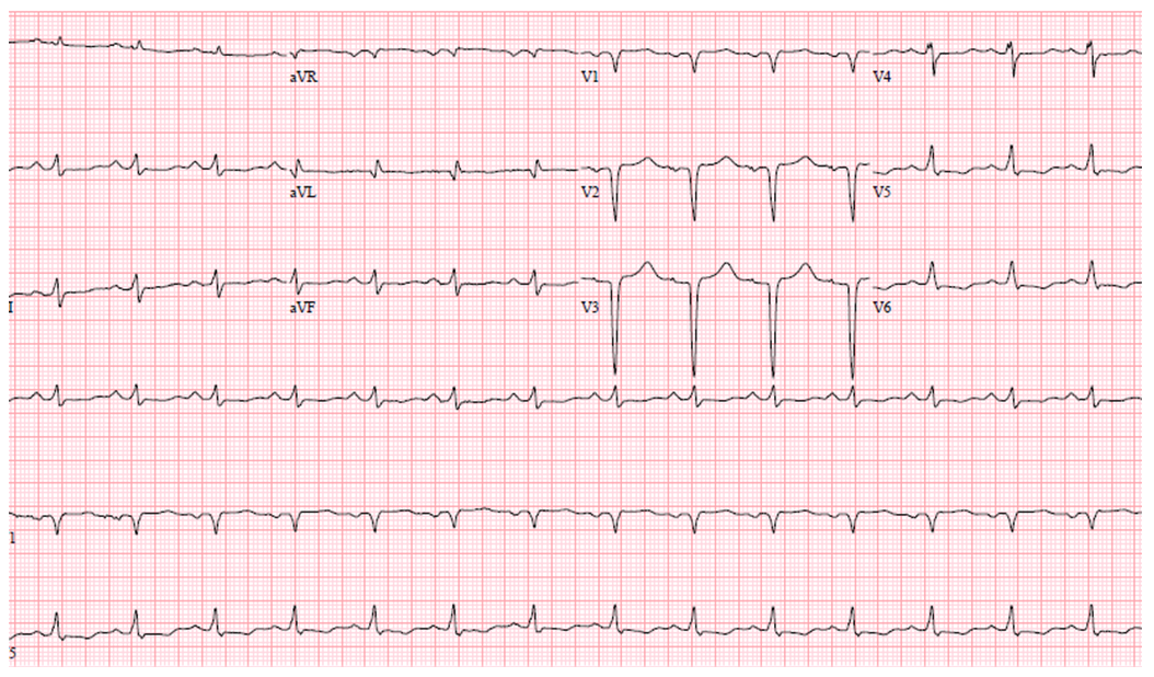 ECG of the Month: 49-Year-Old Male Presents with Progressive Shortness ...