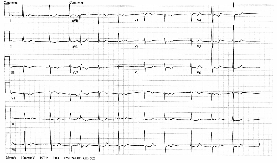 ECG of the Month: A 67-Year-Old Woman with History of Breast Cancer is ...