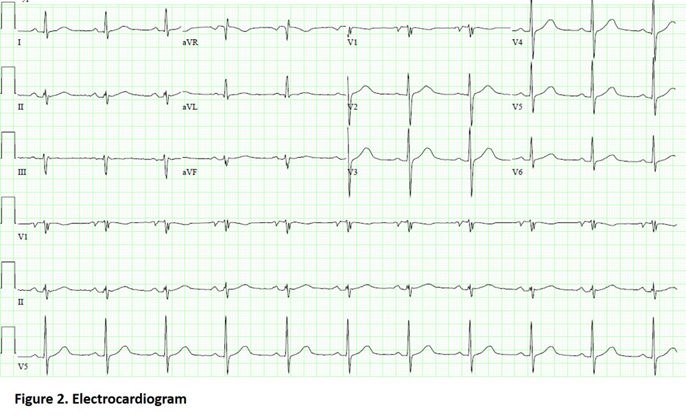 Prophylaxis for Postpericardiotomy Syndrome - American College of Cardiology