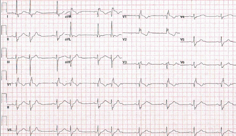ECG of the Month: 77-Year-Old Woman with History of Rheumatoid ...