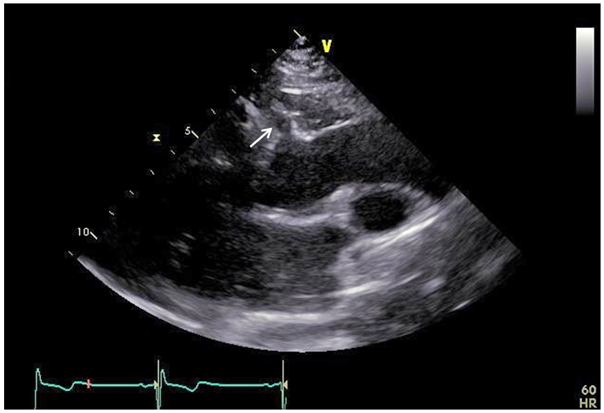 Coronary Artery Dilatation in a Young Woman Presenting With Hemodynamic ...