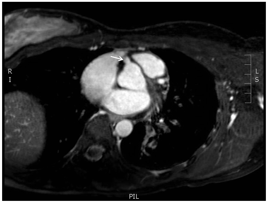 Coronary Artery Dilatation in a Young Woman Presenting With Hemodynamic ...