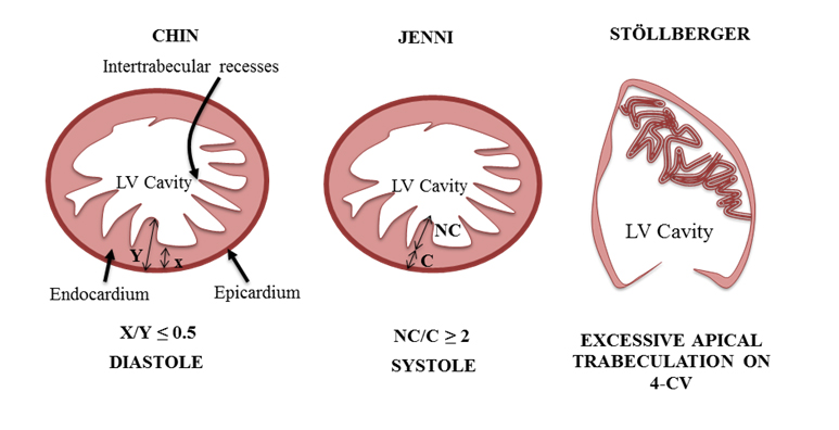 Left Ventricular Trabeculations in Athletes - American College of ...