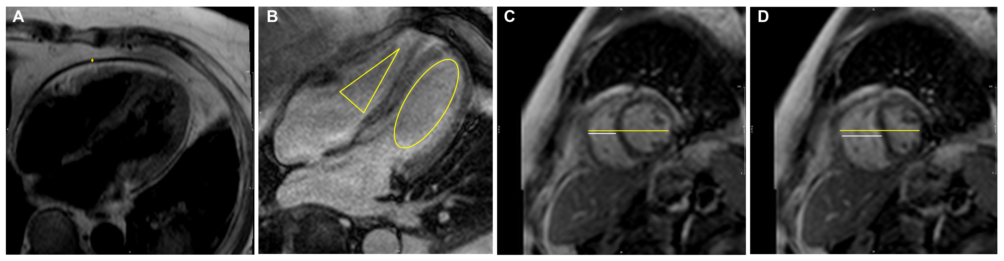 Constrictive Pericarditis Mri