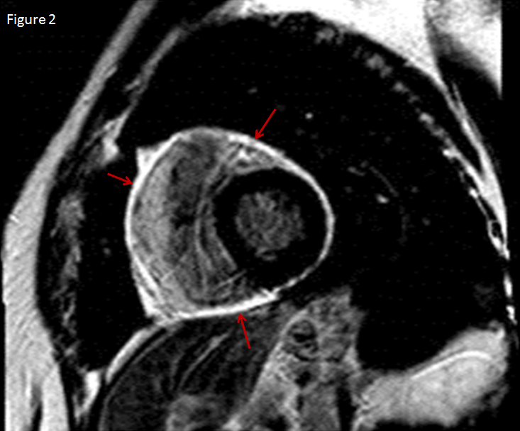 Constrictive Pericarditis Mri