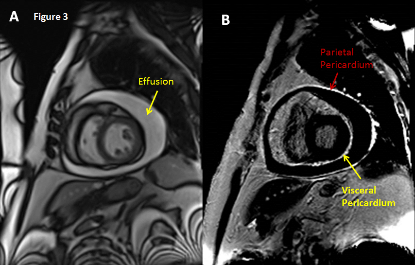 Pericardial Effusion Mri