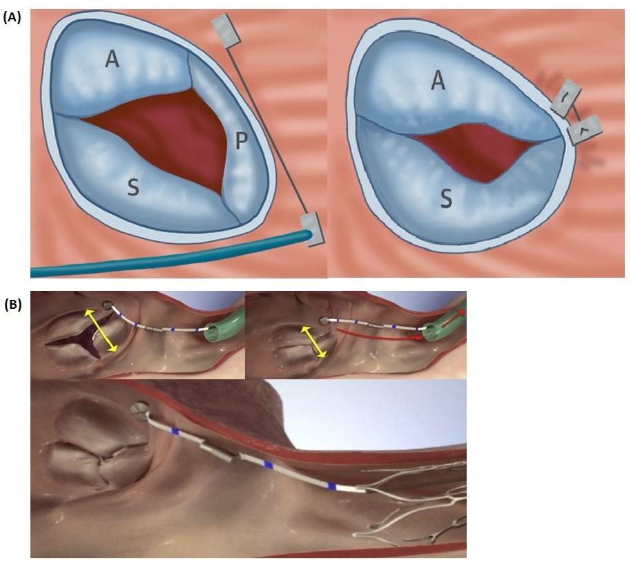 Emerging Transcatheter Therapies For TR - American College of Cardiology