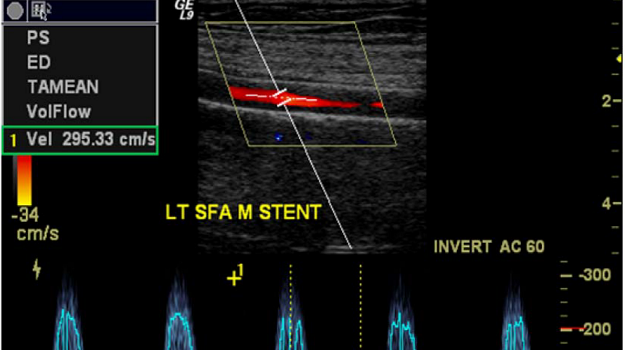 Hemodynamic Assessment for Lower Extremity Intervention – Why, When ...