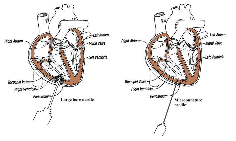 Managing Pericardium in Electrophysiology Procedures - American College ...