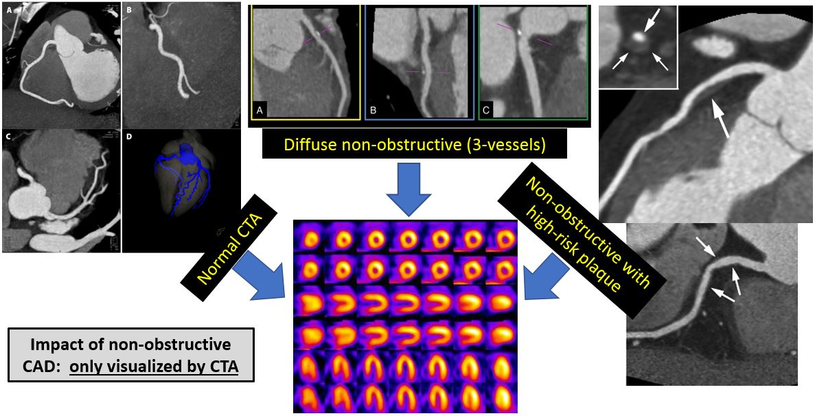 Coronary CTA Should Be The Initial Test In Most Patients With Stable Coronary CTA Should Be The Initial Test In Most Patients With Stable