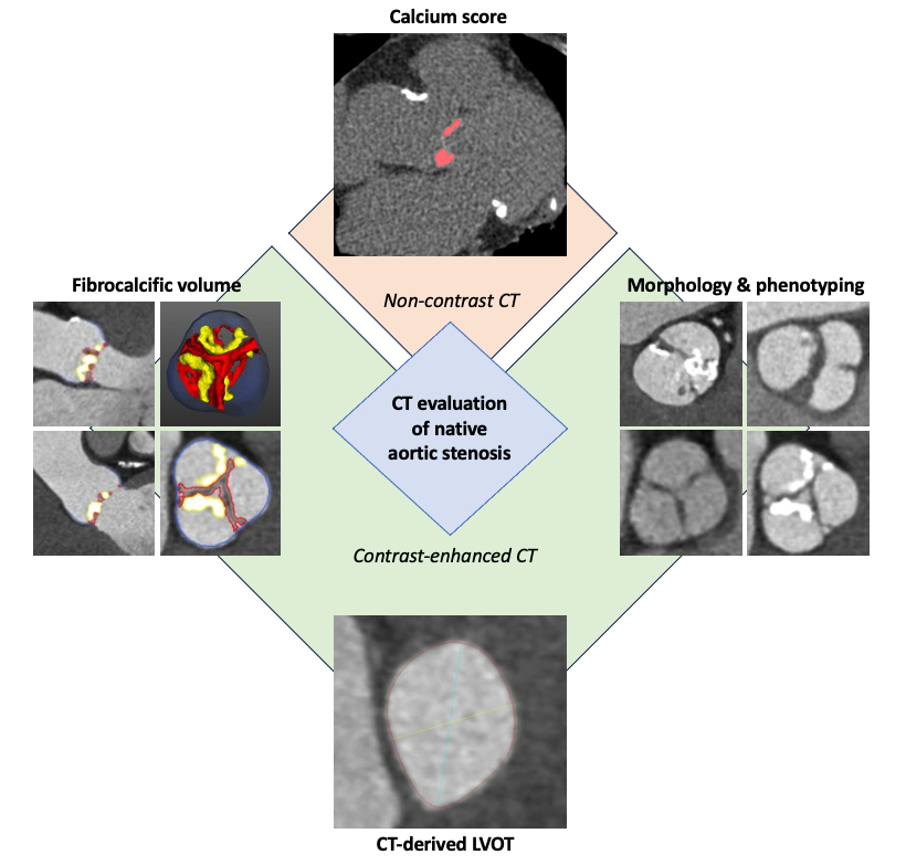 Computed Tomography Evaluation of Native Aortic Stenosis Beyond Calcification Score - American ...