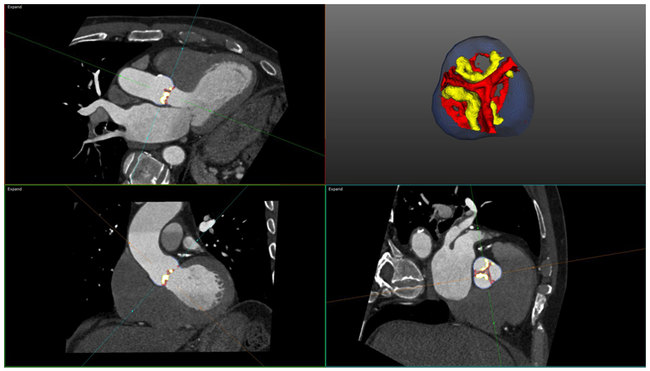 Computed Tomography Evaluation of Native Aortic Stenosis Beyond Calcification Score - American ...