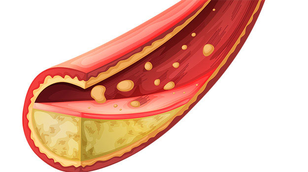Dyslipidemia - American College of Cardiology