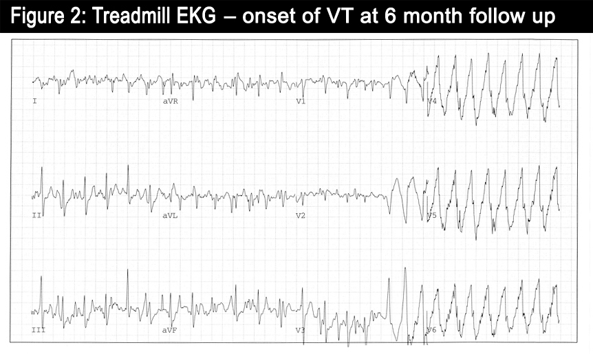 Wide Complex Tachycardia - American College of Cardiology