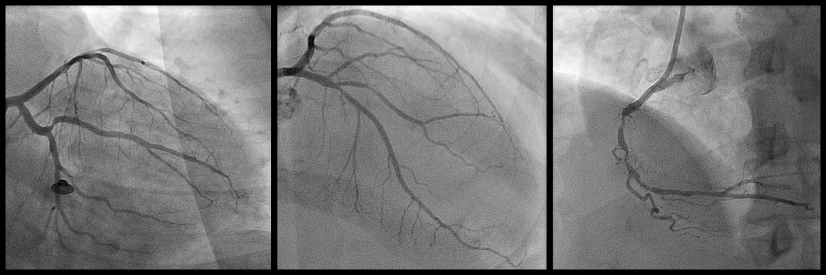 A Patient With a History of HTN and Hyperlipidemia Was Referred For a ...