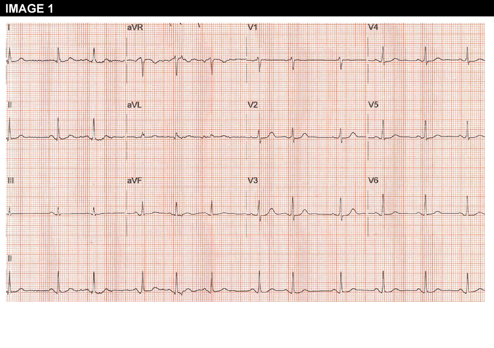 Angina Pectoris Despite Normal Coronary Angiography: Need for ...