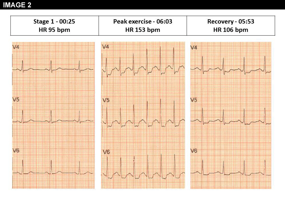 Angina Pectoris Despite Normal Coronary Angiography: Need for ...