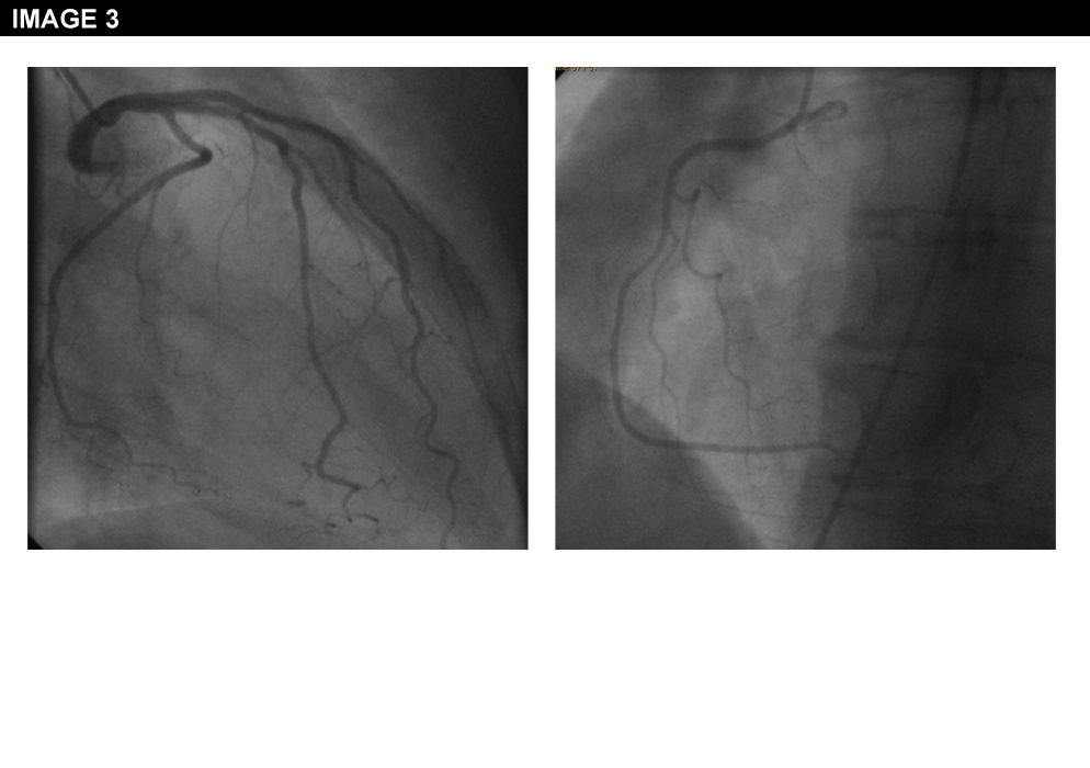 Angina Pectoris Despite Normal Coronary Angiography: Need for ...
