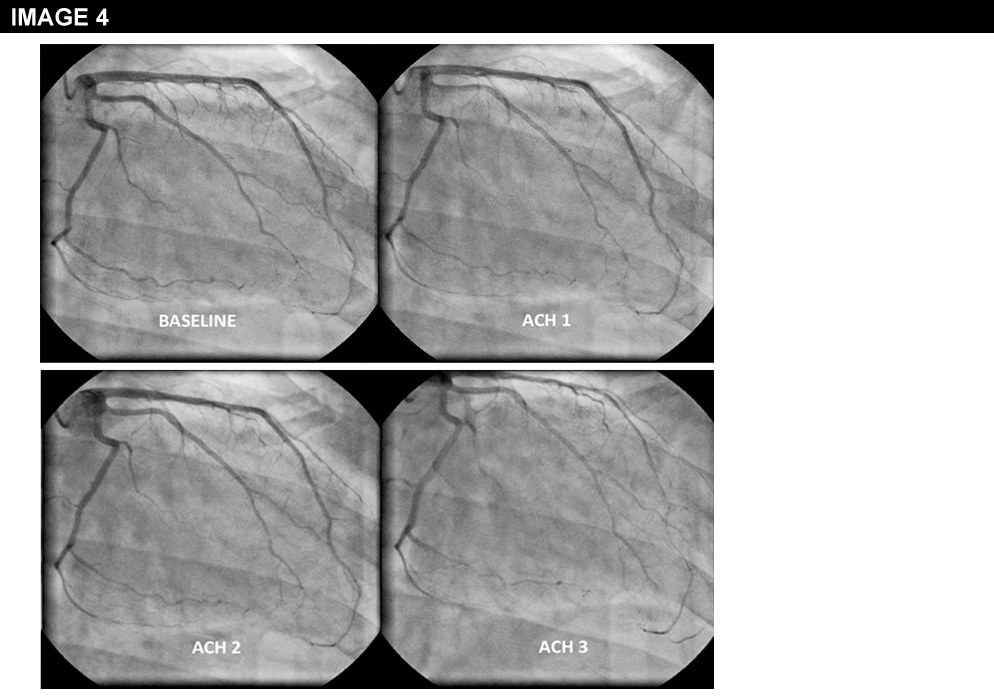 Angina Pectoris Despite Normal Coronary Angiography: Need for ...