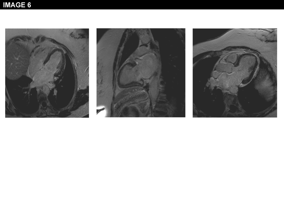 Angina Pectoris Despite Normal Coronary Angiography: Need for ...