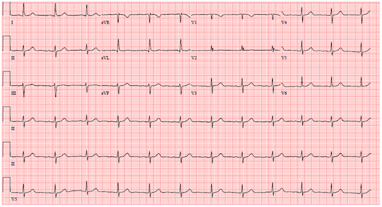 New Angina in a Patient With Stable Coronary Disease - American College ...