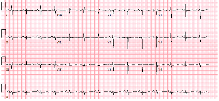 From Normal Sinus to Ventricular Tachycardia Arrest - The Sinister Role ...
