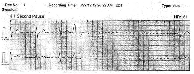 From Normal Sinus to Ventricular Tachycardia Arrest - The Sinister Role ...