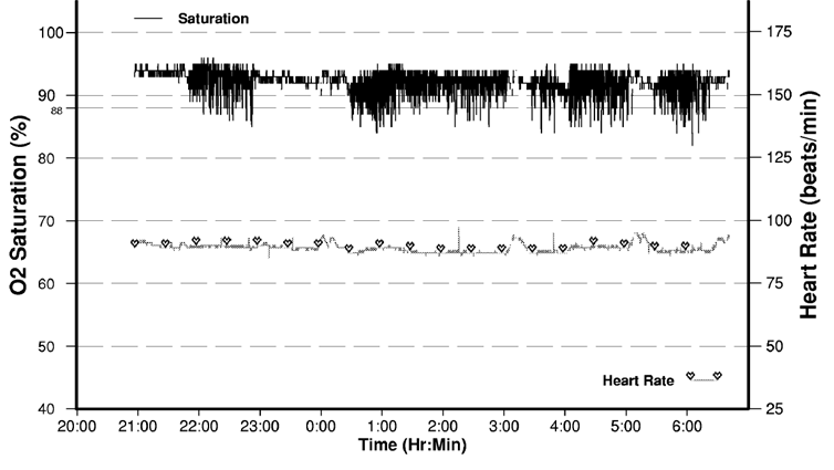 Interaction of Sleep Apnea With Cardiovascular Disease - American ...