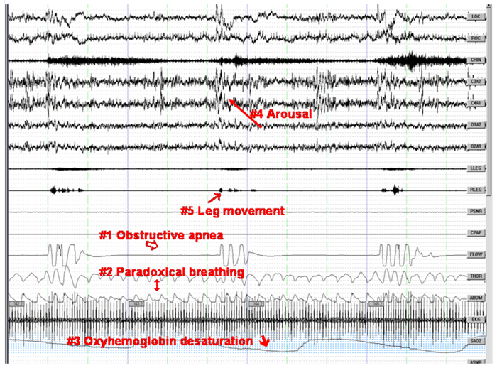 Obstructive Sleep Apnea and Sleep-Disordered Breathing in Heart Failure ...