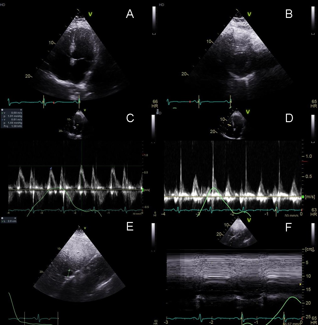 Dyspnea Following Electrophysiology Ablation - American College of ...