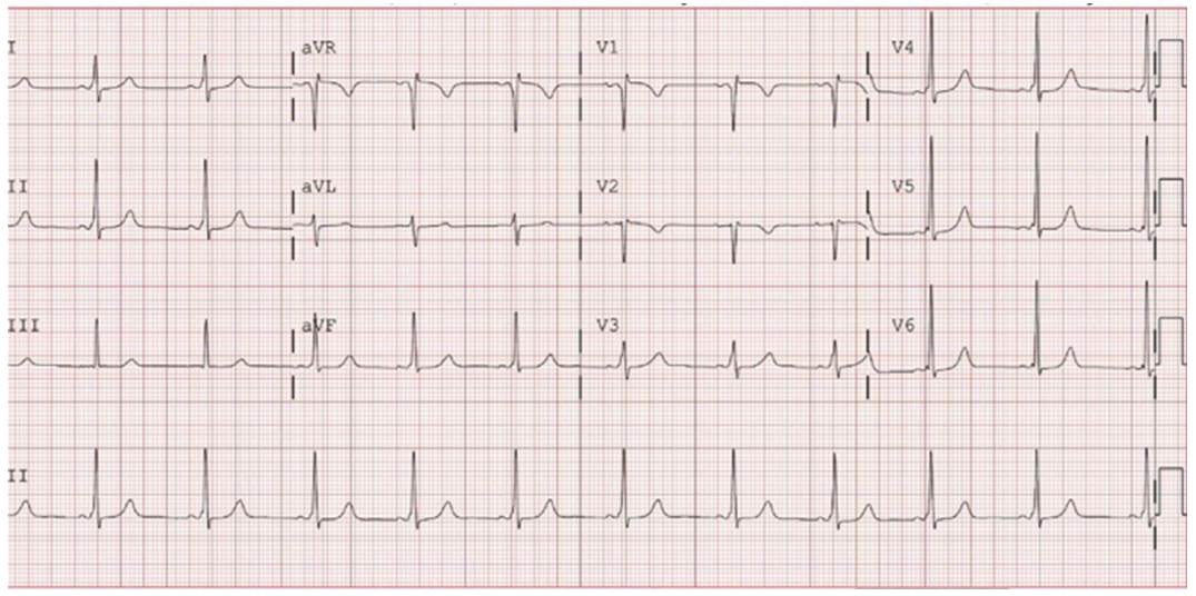 An 18-Year-Old Basketball Player With Pre-Excitation on an ...