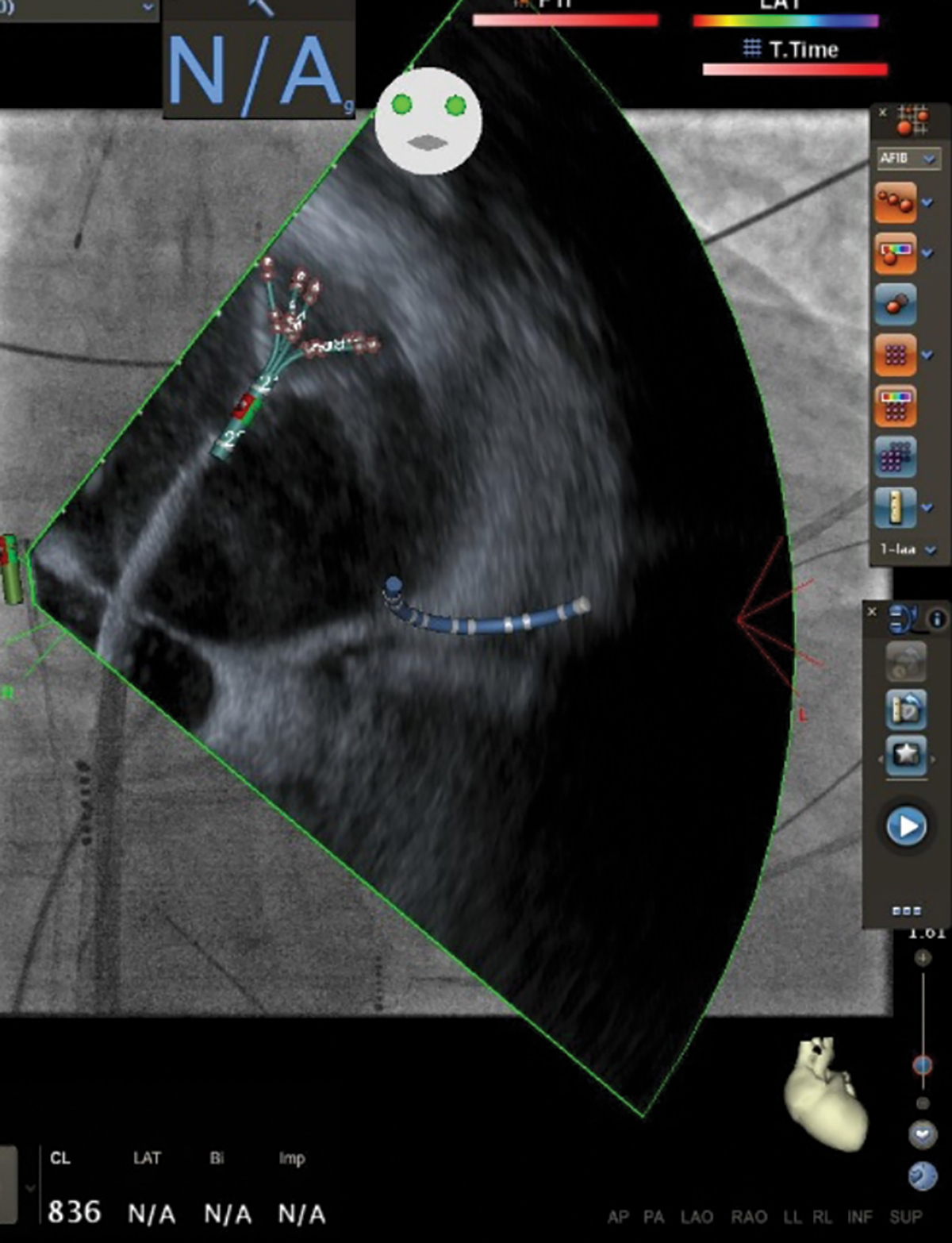Focus on EP | Fluoroless Ablations For Cardiac Arrhythmias - American ...
