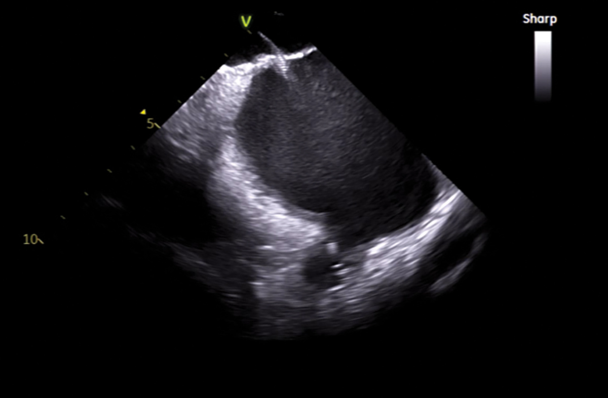 Focus on EP | Fluoroless Ablations For Cardiac Arrhythmias - American ...