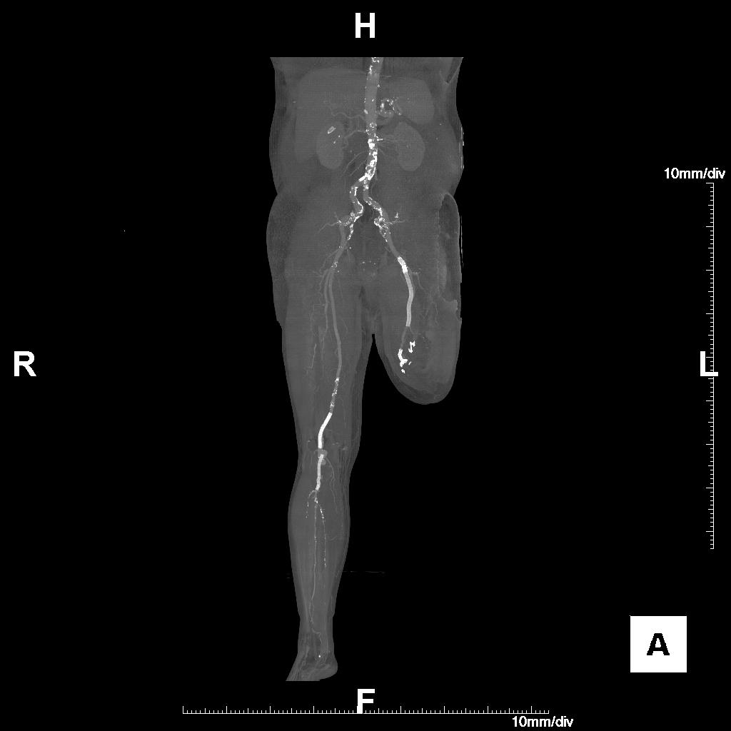 Management of Popliteal Artery Aneurysm - American College of Cardiology